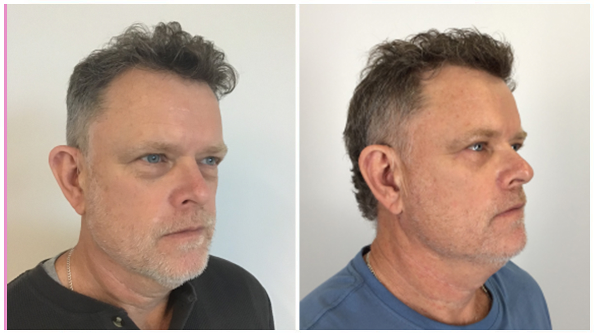 Fat Transfer to Face Before and After | Dr Sawhney | Sculpted Clinic